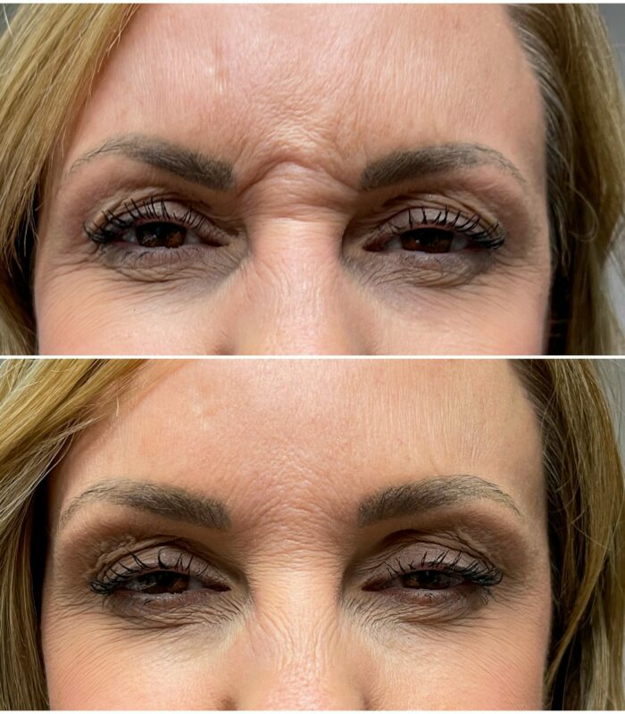 Botox - Milwaukee Eye Care
