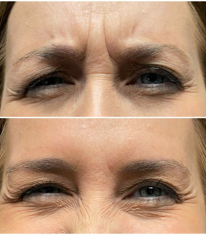 Botox - Milwaukee Eye Care