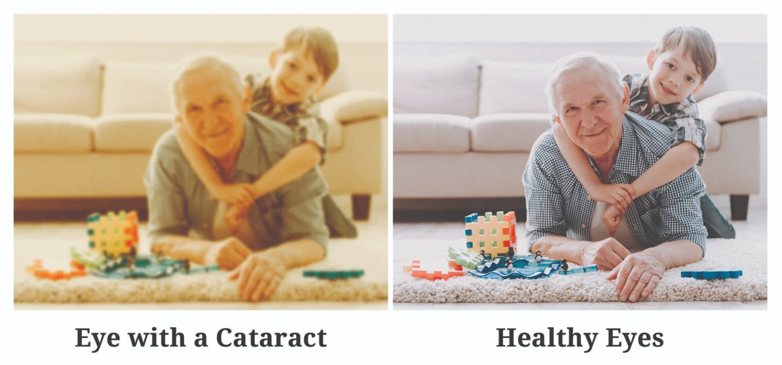 Cataract Surgeons Milwaukee | Laser Cataract Surgery Milwaukee, WI