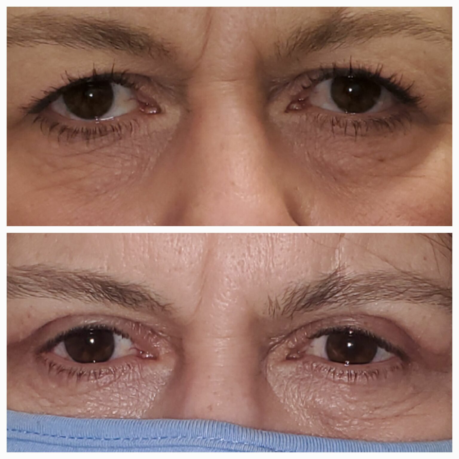 Eyelid Surgery - Milwaukee Eye Care